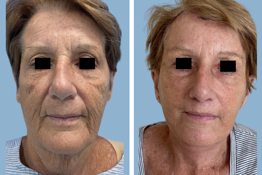 Before and After Pictures of Face Plastic Surgery Results