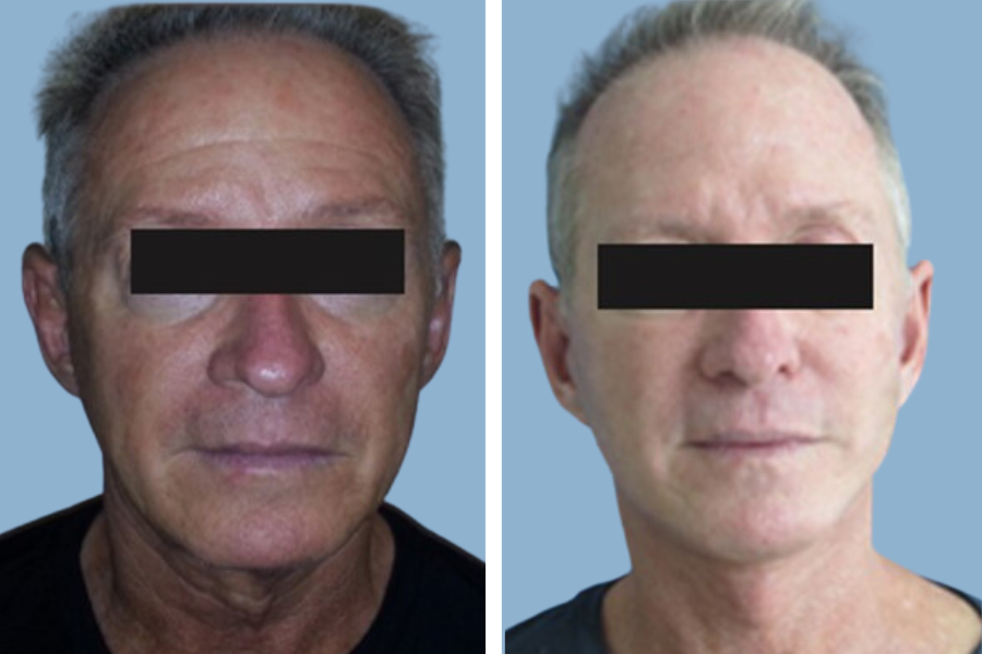 Before and After Pictures of Face Plastic Surgery Results