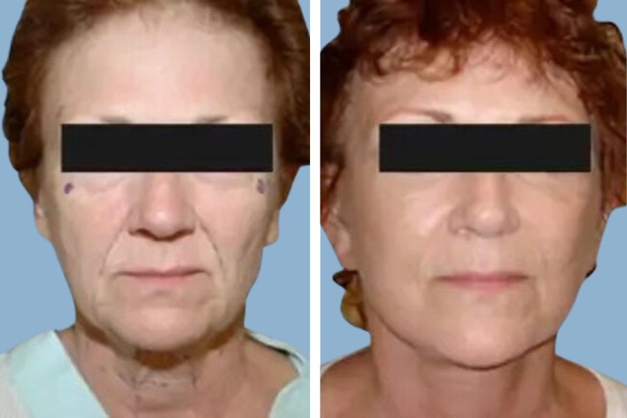 Before and After Pictures of Face Plastic Surgery Results