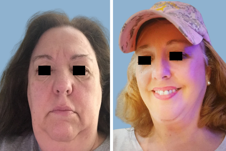 Before and After Pictures of Face Plastic Surgery Results