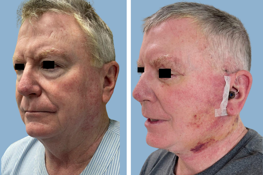 Before and After Pictures of Face Plastic Surgery Results