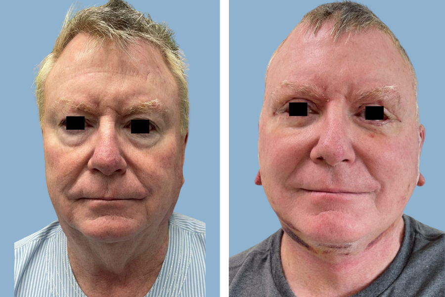 Before and After Pictures of Face Plastic Surgery Results